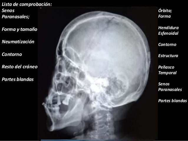 Radiografia spn y orbita