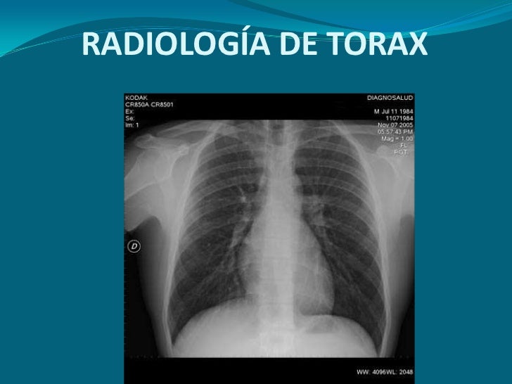 Partes De Rx Torax