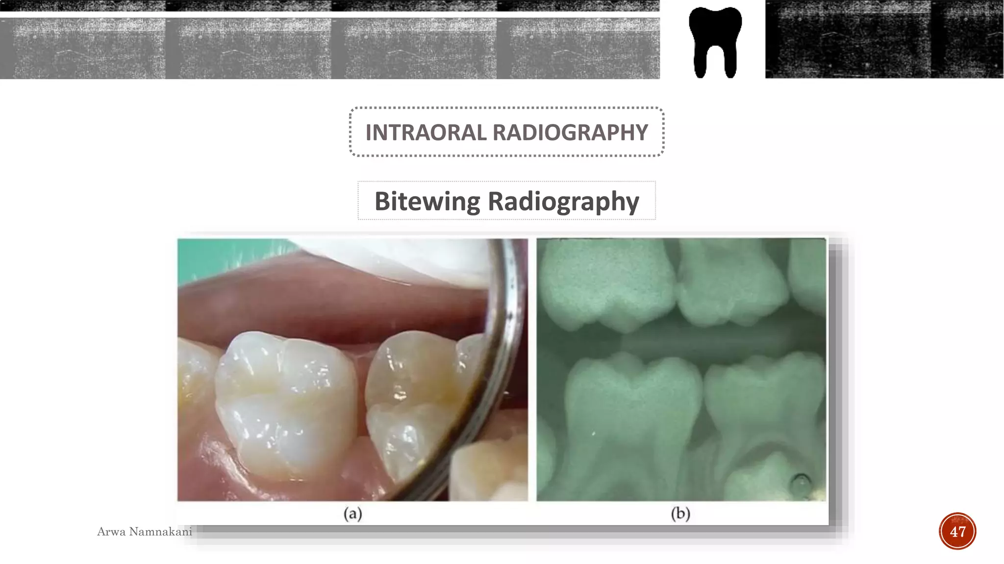 Radiograph Techniques in Pediatric Dentistry | PPTX