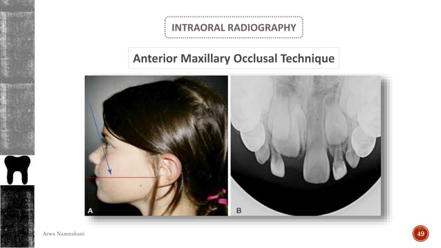 Radiograph Techniques in Pediatric Dentistry | PPTX