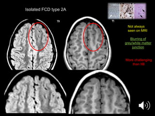 Epilepsy getting the most out of neuroimaging 2019 | PPTX