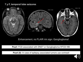 Epilepsy getting the most out of neuroimaging 2019 | PPTX