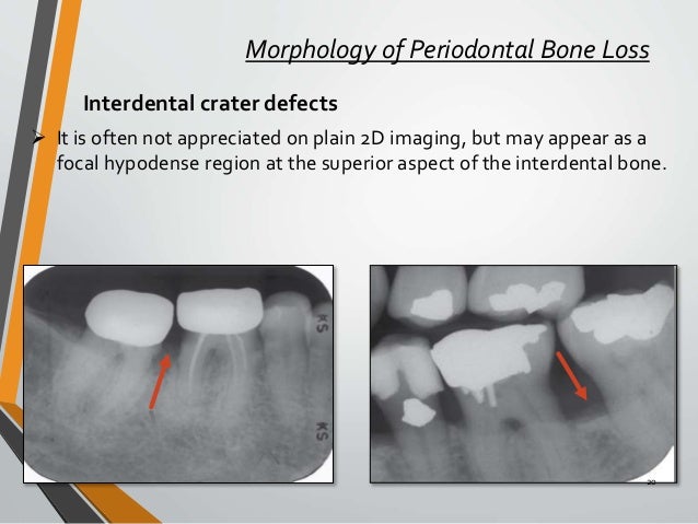 Radiographic aids in dx of periodontol ds part b
