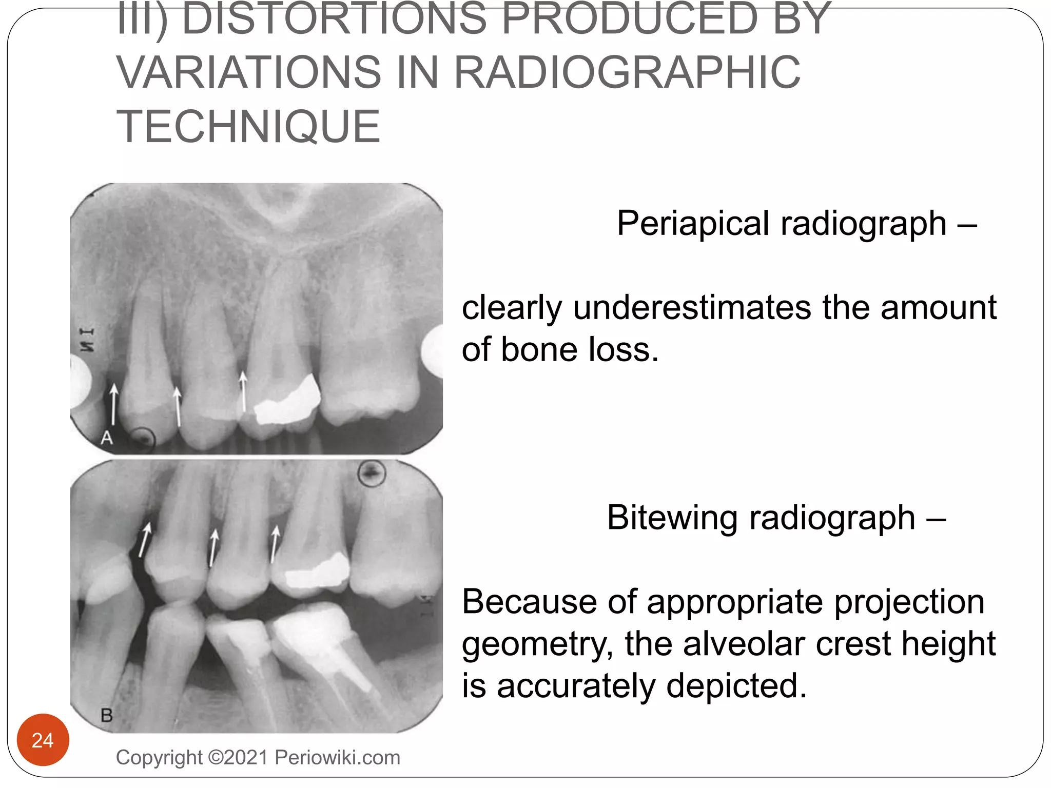 Radiographic aids in periodontal disease diagnosis part I | PPTX