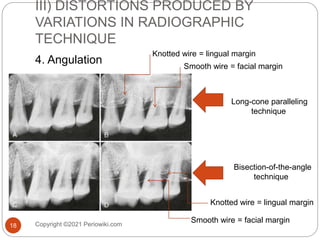 Radiographic aids in periodontal disease diagnosis part I | PPTX