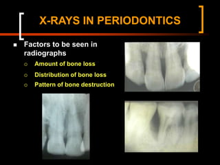 radiographic aids in the diagnosis of periodontal disease.ppt