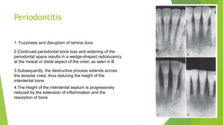 Radiographic Aids in the Diagnosis of Periodontal Diseases.pptx