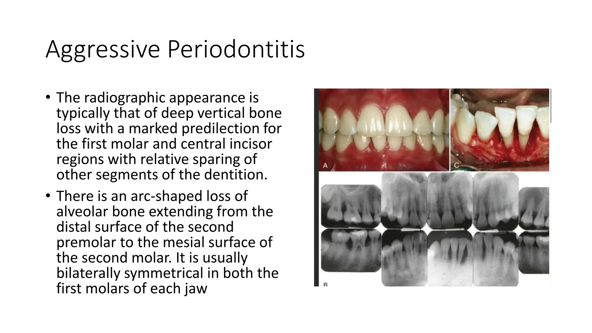 RADIOGRAPHIC AIDS IN THE DIAGNOSIS OF PERIODONTAL DISEASES.pptx