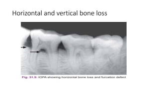 RADIOGRAPHIC AIDS IN THE DIAGNOSIS OF PERIODONTAL DISEASES.pptx