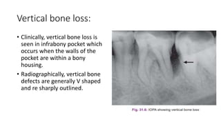 RADIOGRAPHIC AIDS IN THE DIAGNOSIS OF PERIODONTAL DISEASES.pptx ...