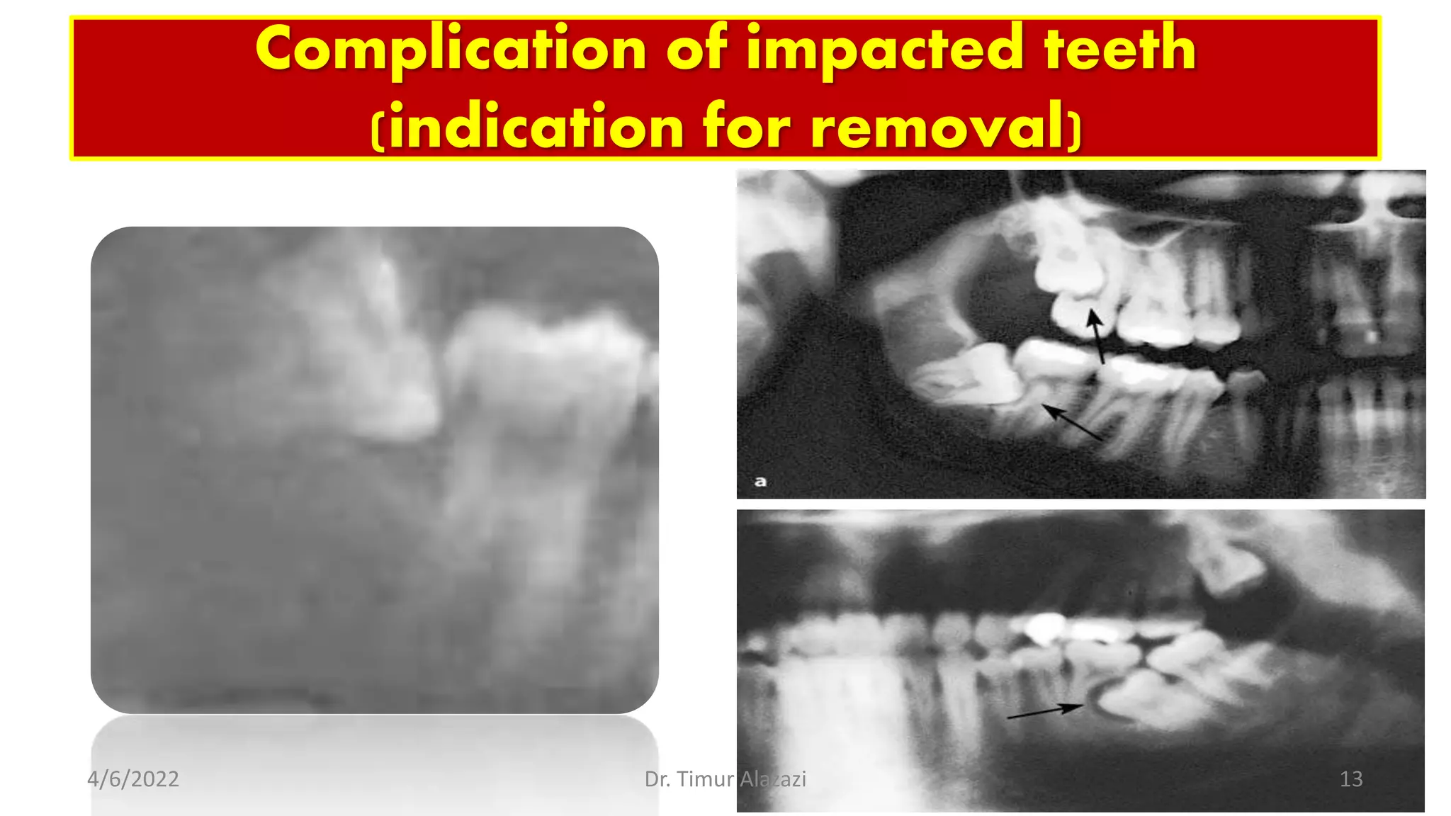 Radiographical assesment of impacted teeth | PPTX
