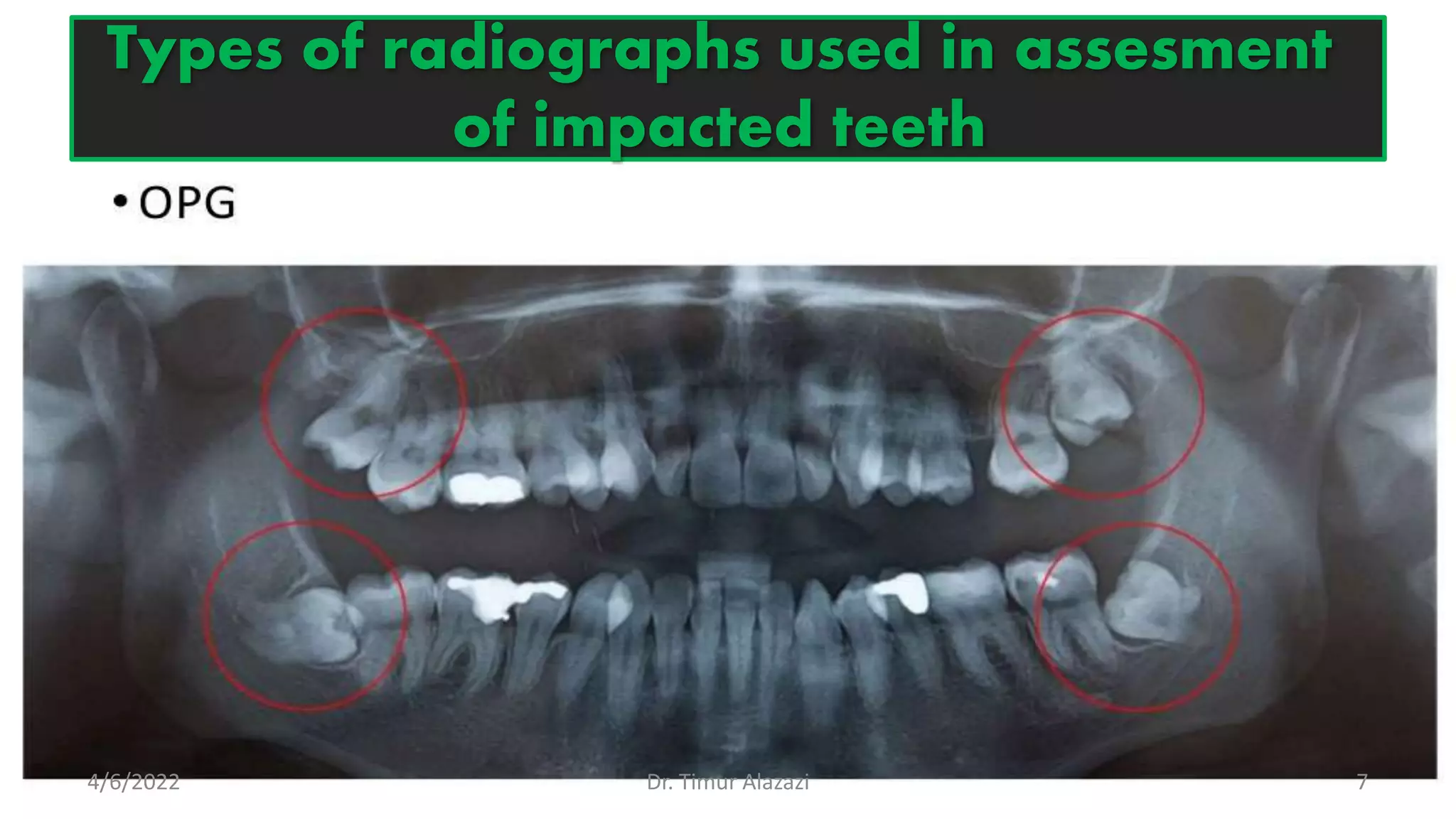 Radiographical assesment of impacted teeth | PPTX