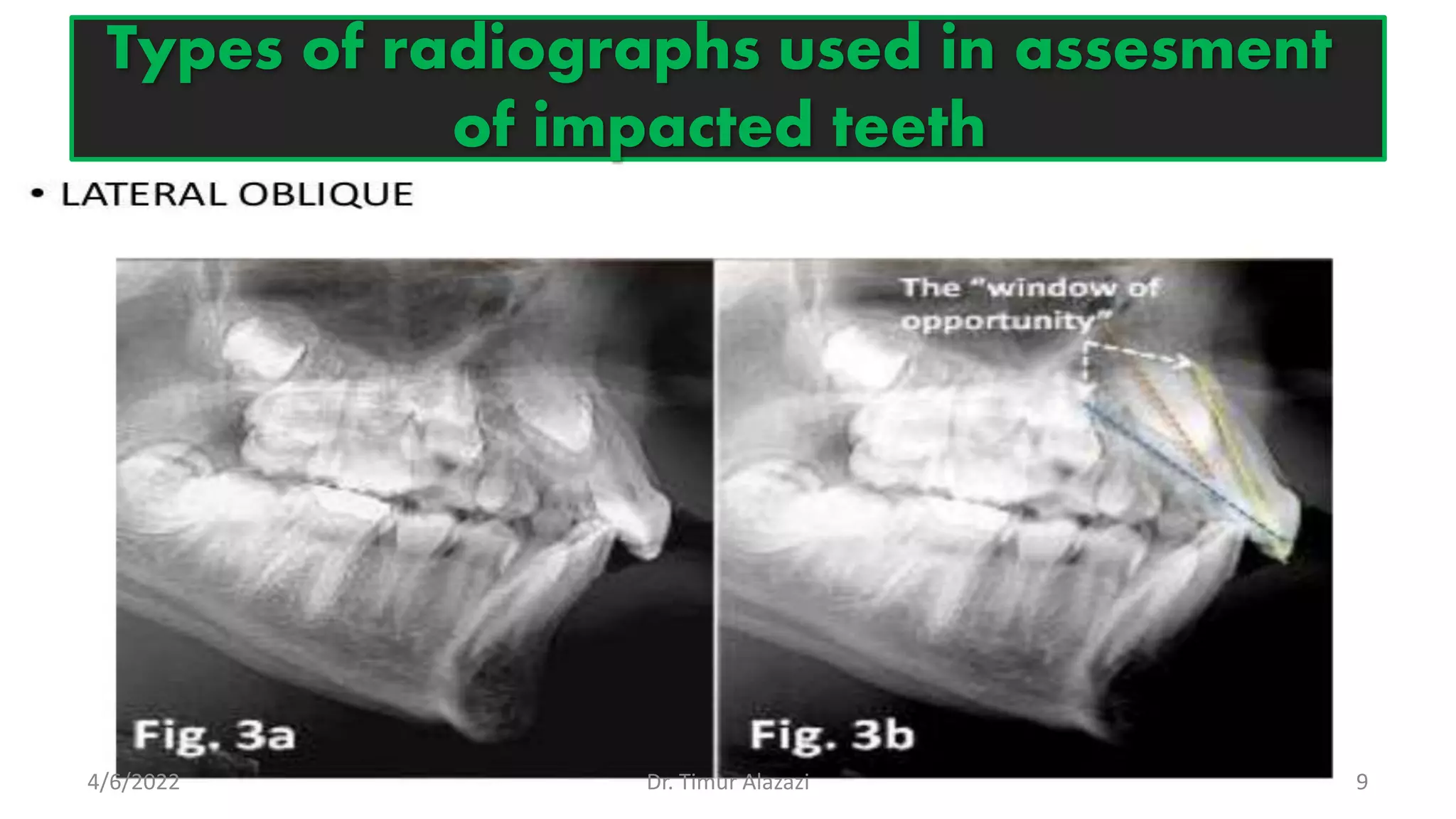 Radiographical assesment of impacted teeth | PPTX