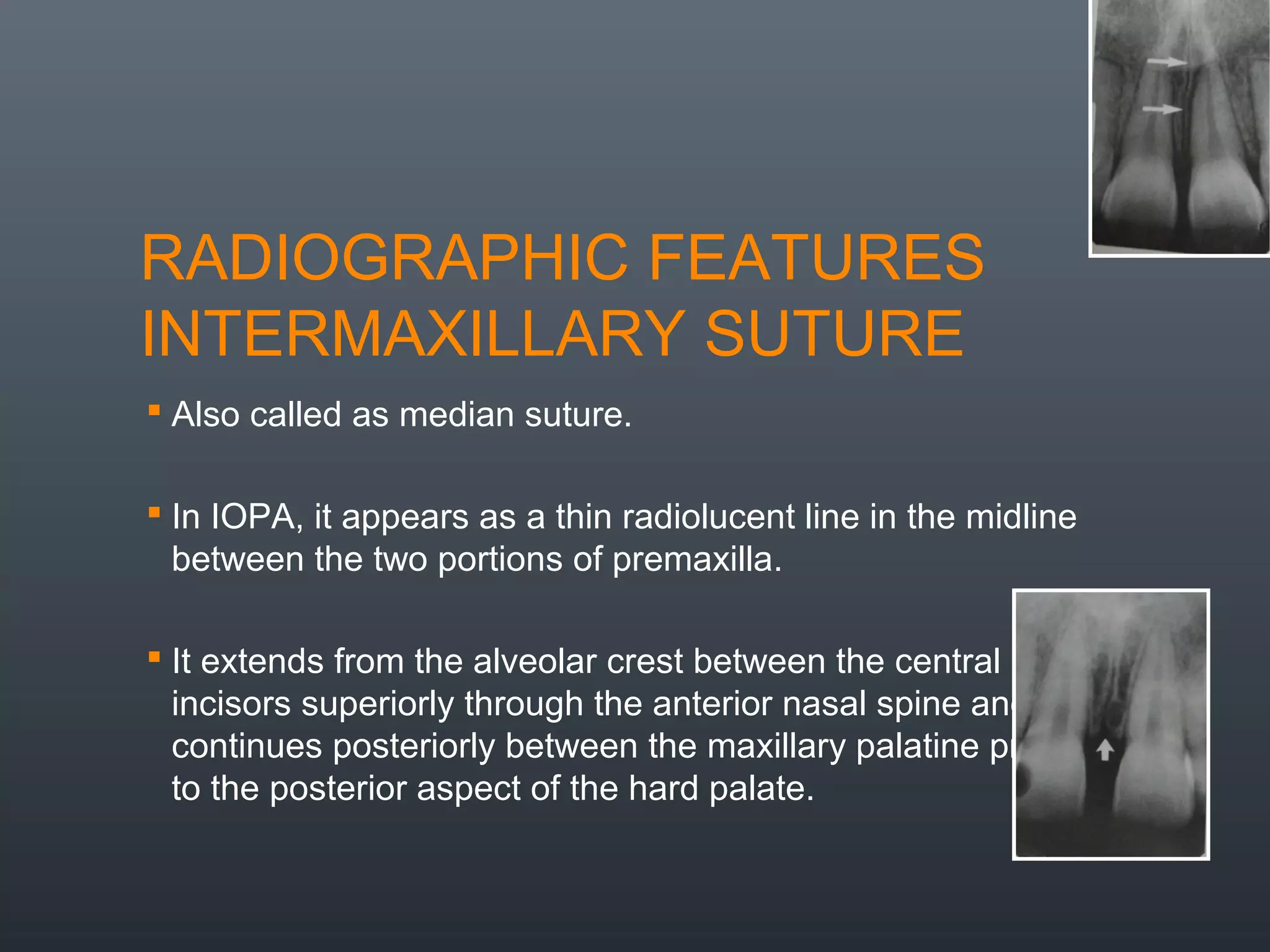 Radiographic anatomical landmarks By Dr. Armaan Singh | PPT