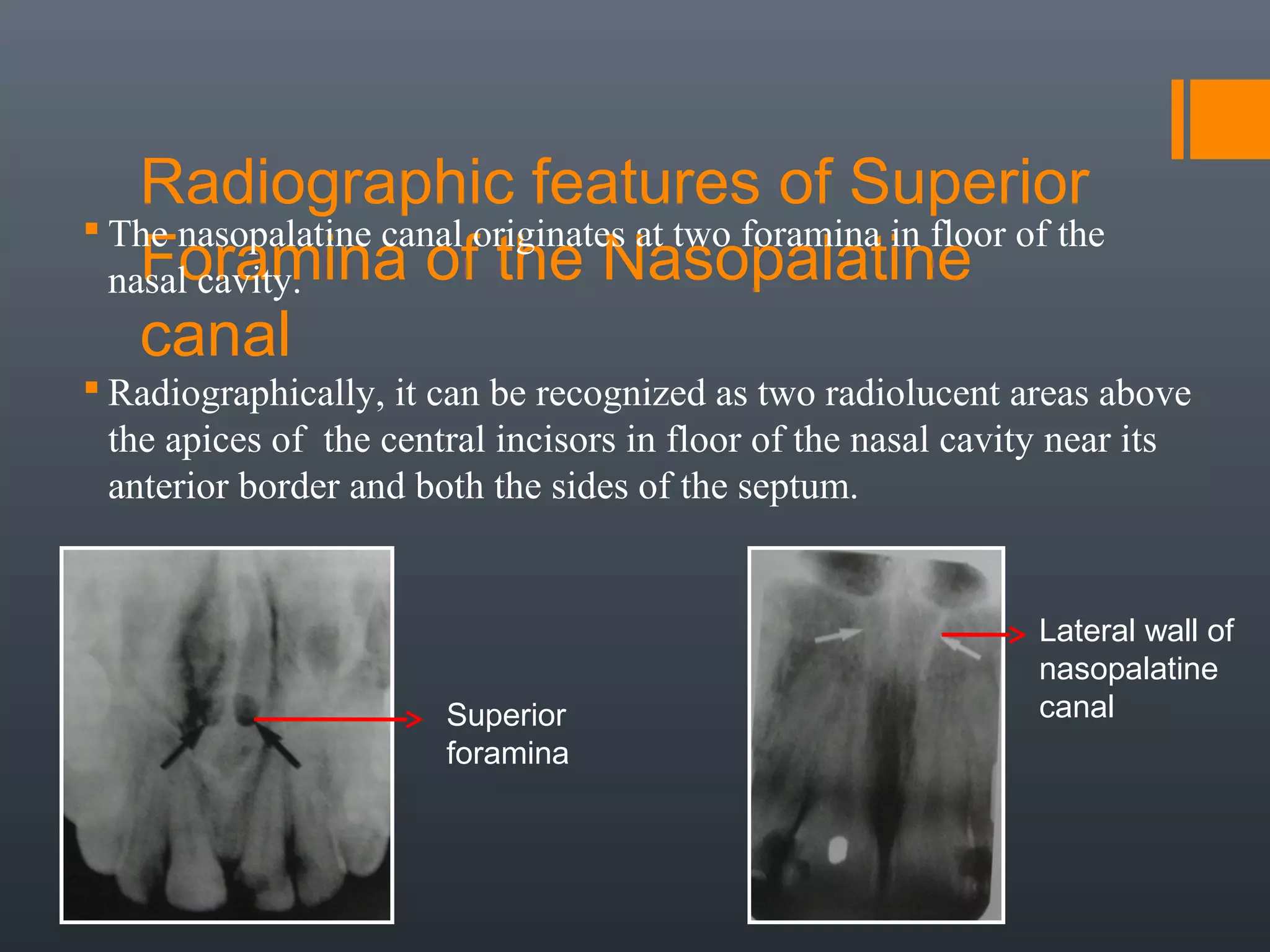 Radiographic anatomical landmarks By Dr. Armaan Singh | PPT
