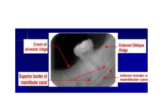 DENTAL RADIOGRAPHIC ANATOMICAL LANDMARKS .pdf