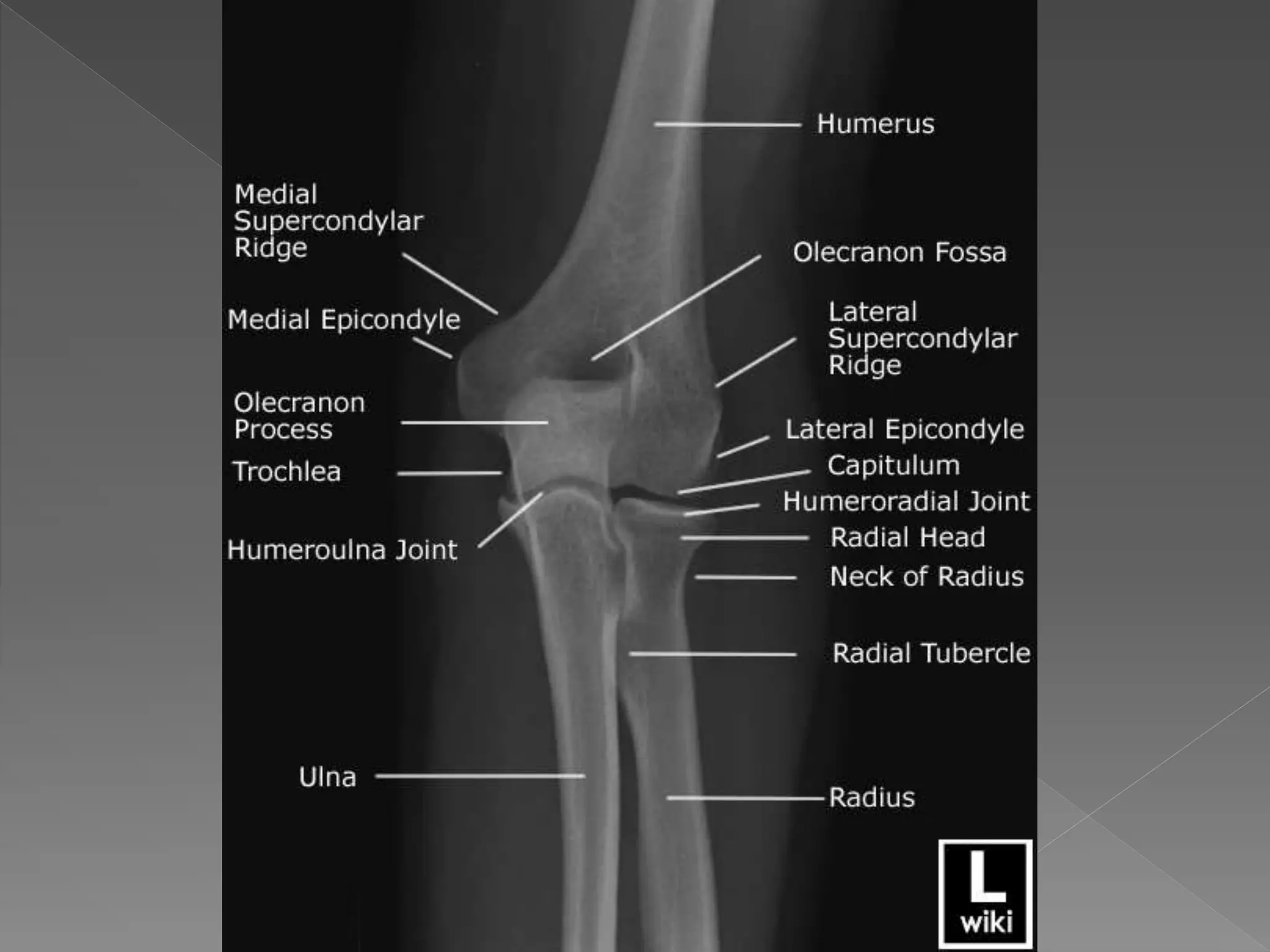 Radiographic anatomy of upper limb | PPTX | Medical Tests | Medical Health