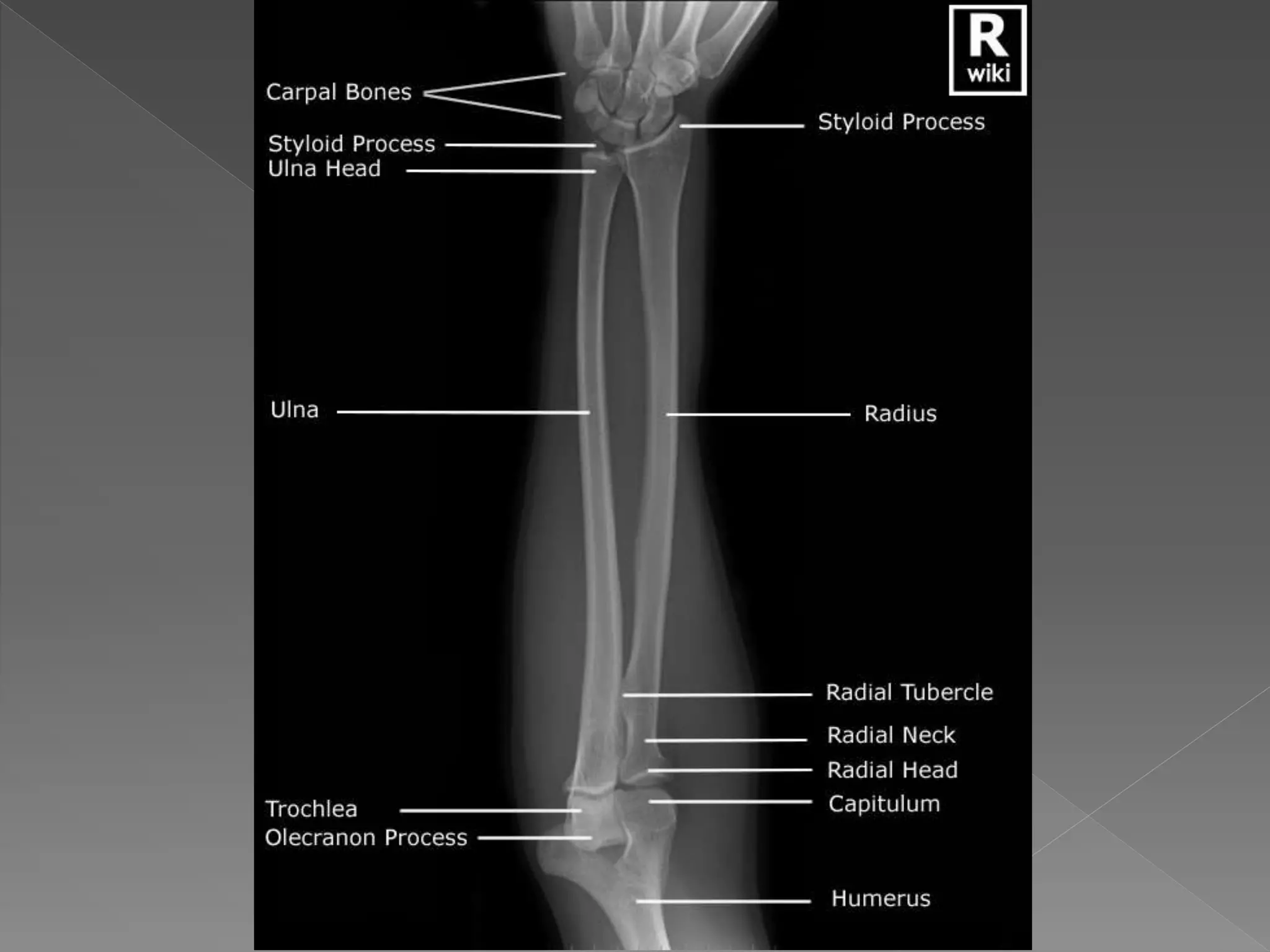 Radiographic anatomy of upper limb | PPTX