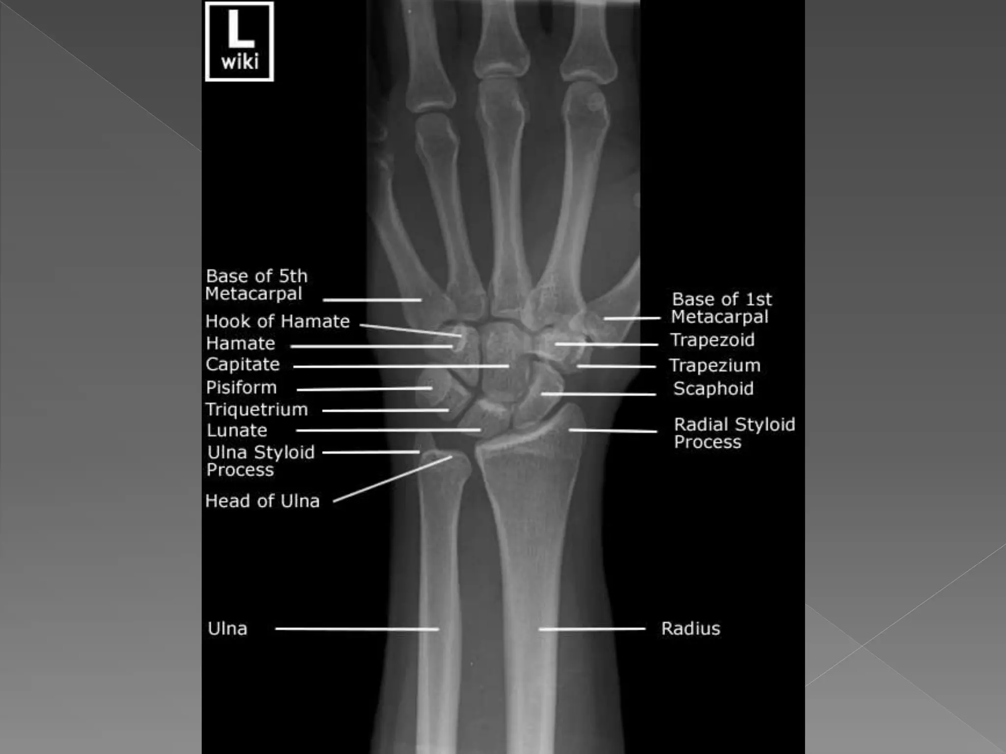 Radiographic anatomy of upper limb | PPTX