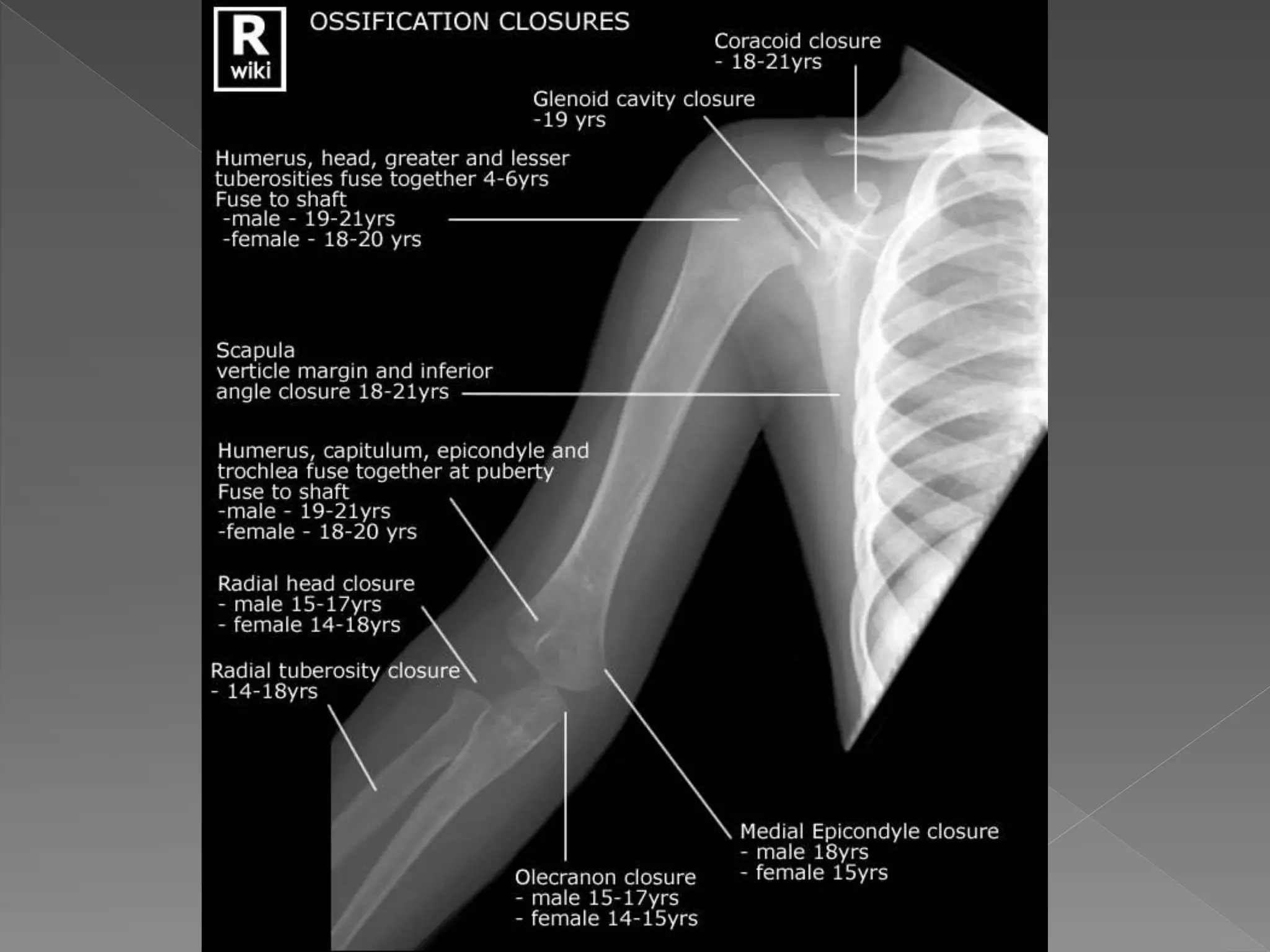 Radiographic anatomy of upper limb | PPTX