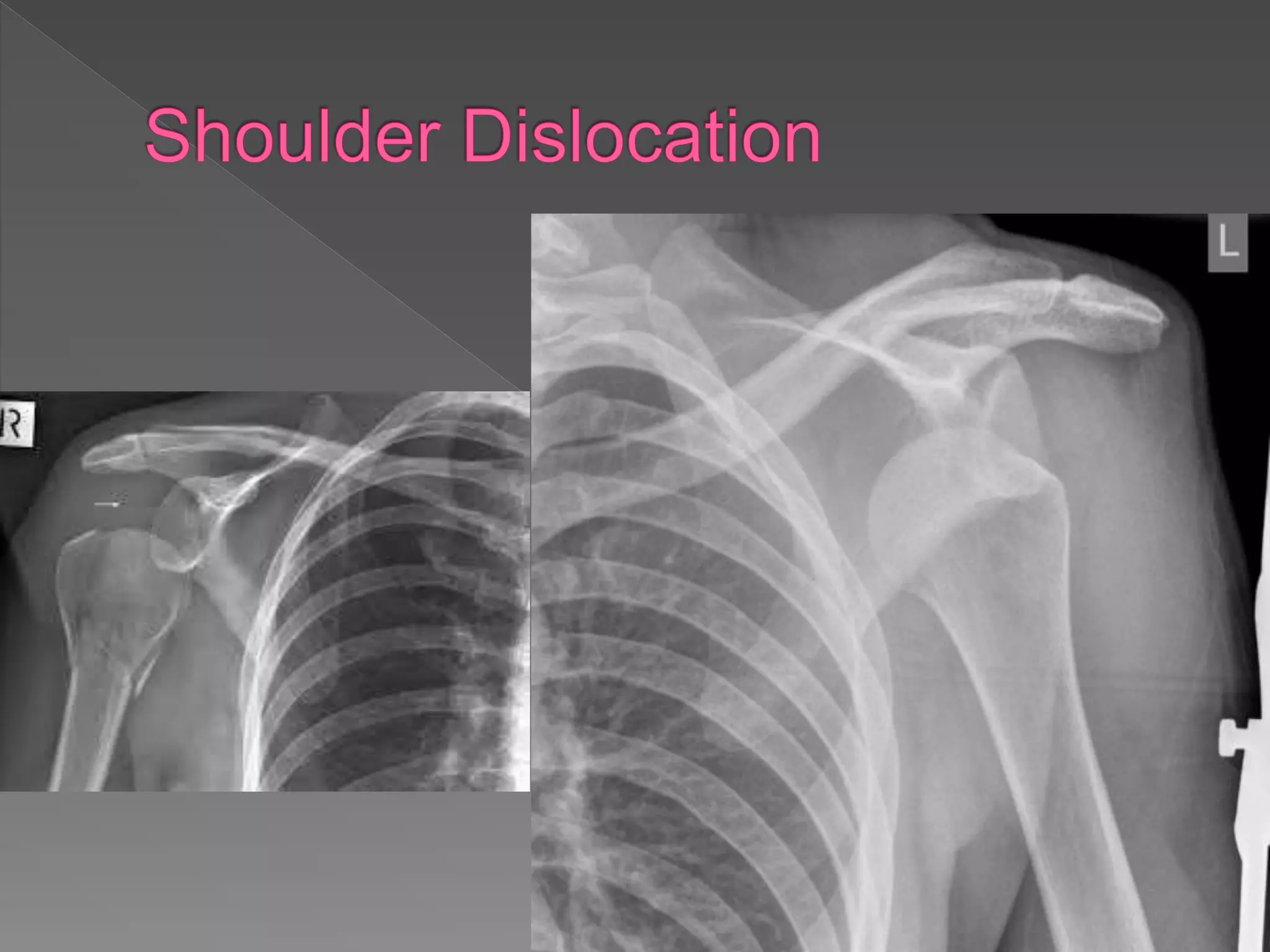 Radiographic anatomy of upper limb | PPTX