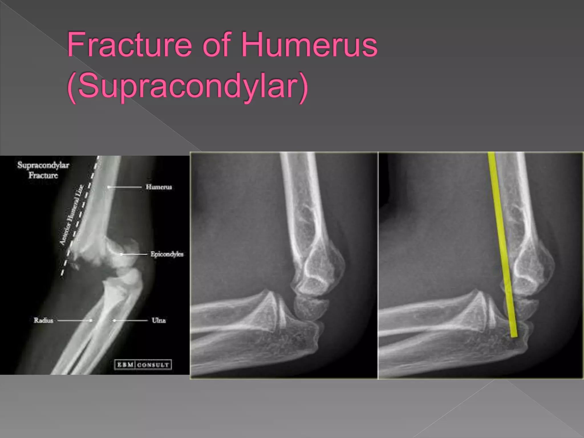 Radiographic anatomy of upper limb | PPTX