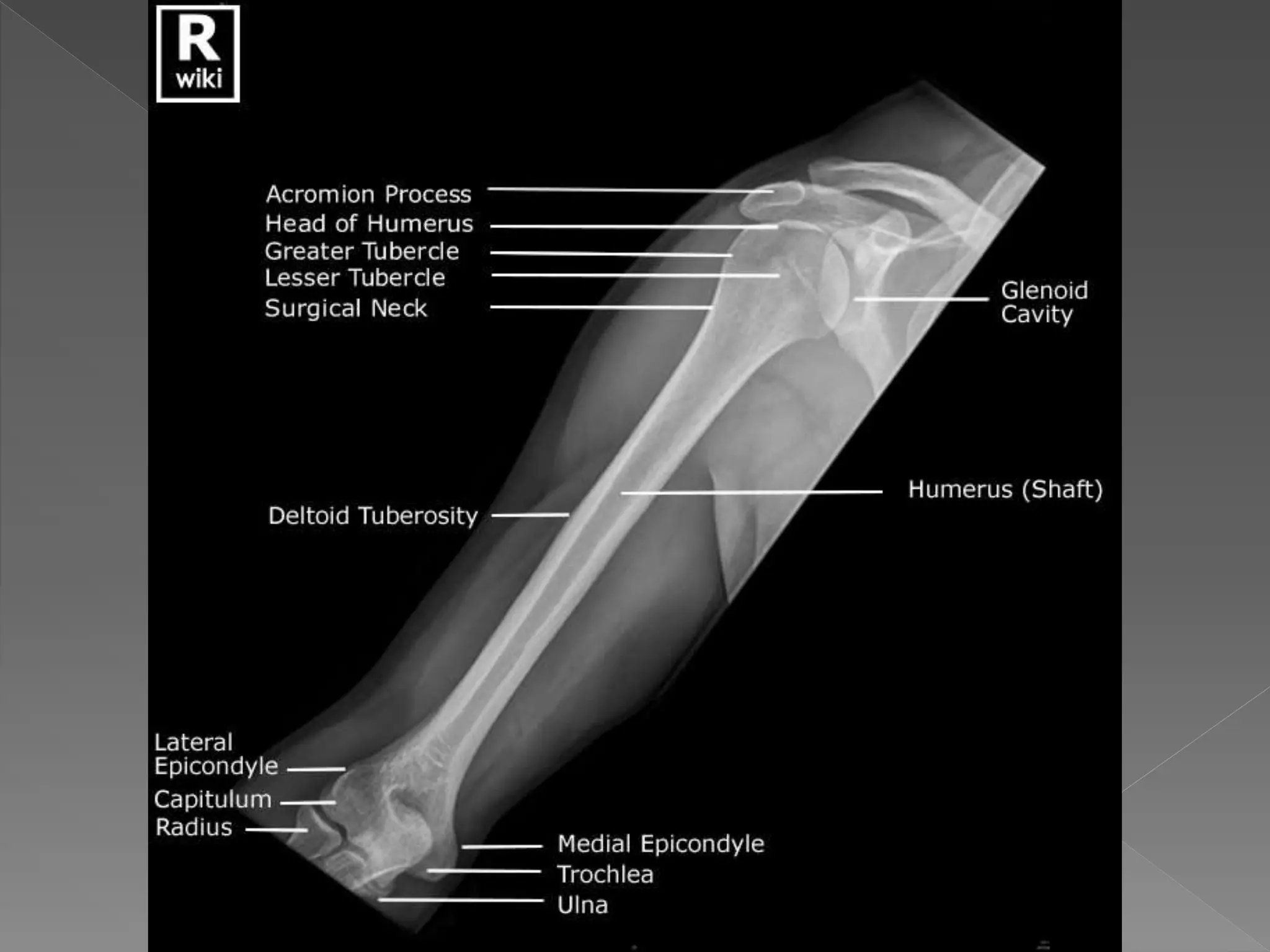 Radiographic anatomy of upper limb | PPTX