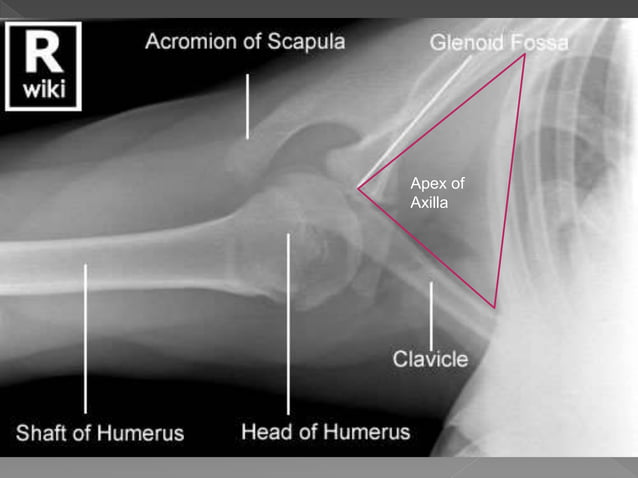 Radiographic anatomy of upper limb | PPTX