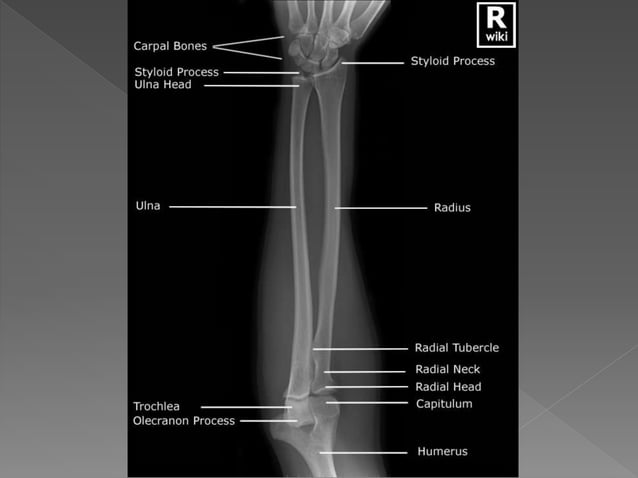 Radiographic anatomy of upper limb
