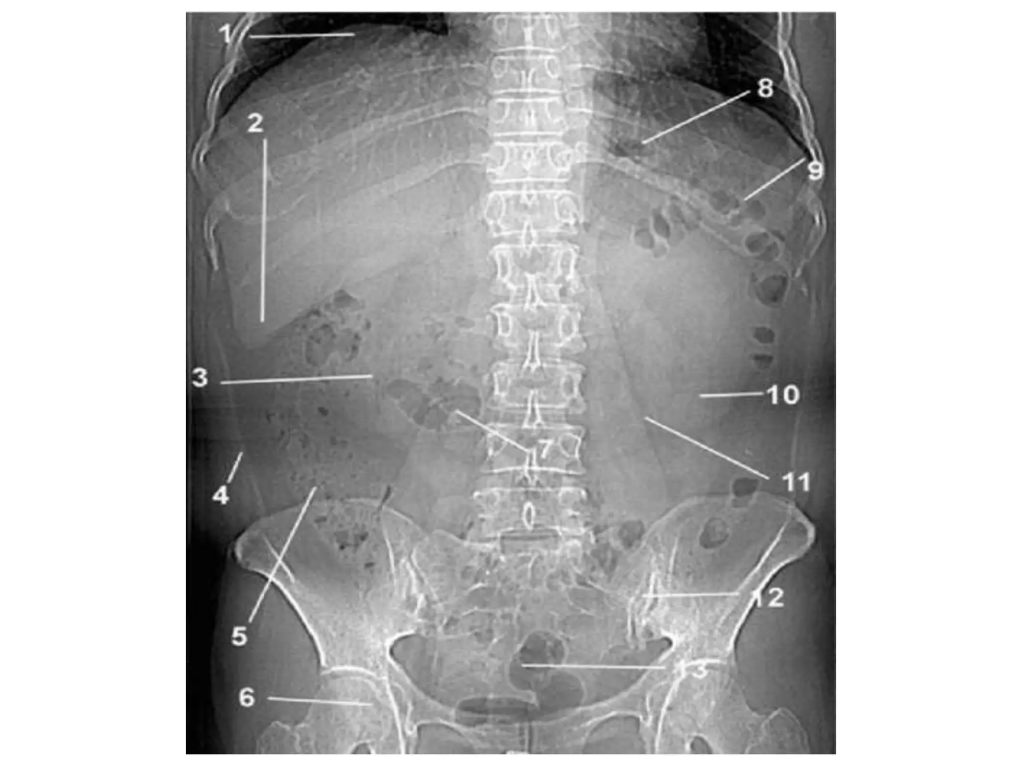 Radiographic anatomy of abdomen Region | PPTX