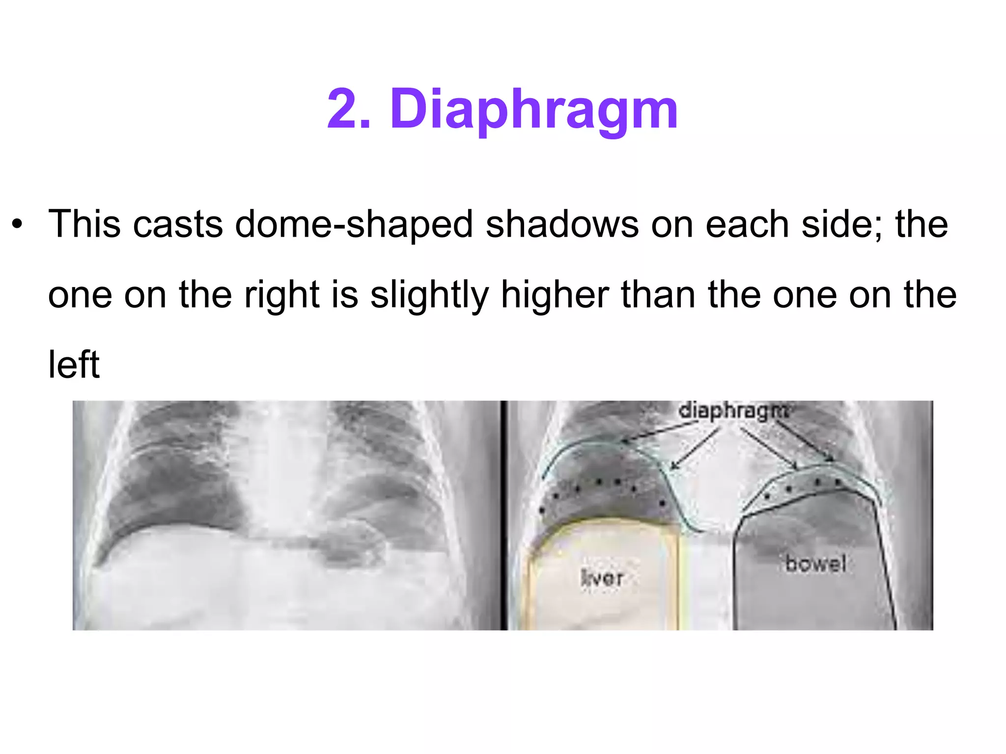 Radiographic anatomy of abdomen Region | PPTX