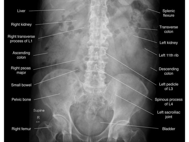 Radiographic anatomy of abdomen Region | PPTX