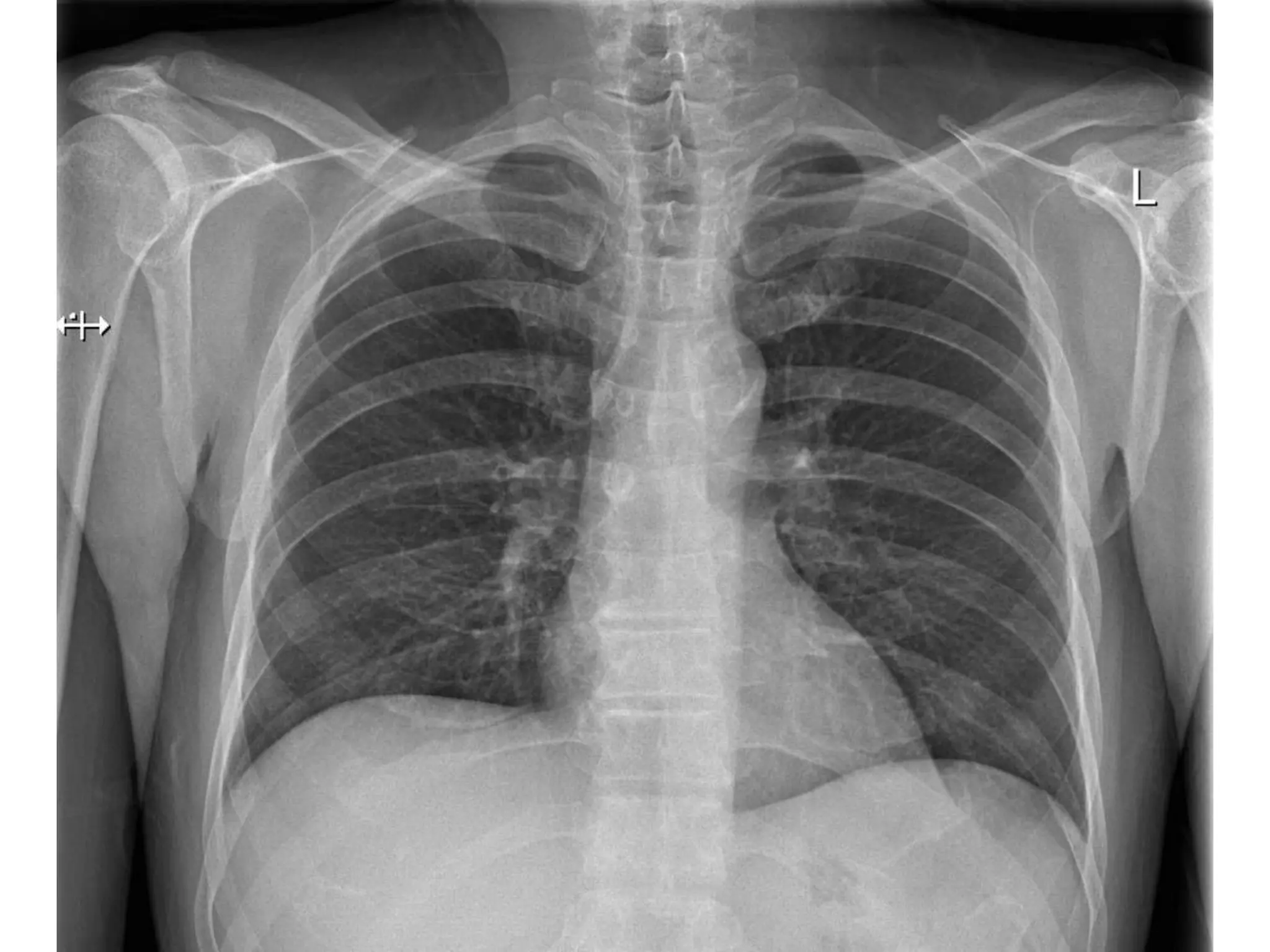 Radiographic anatomy of chest region | PPTX | Lung and Respiratory ...