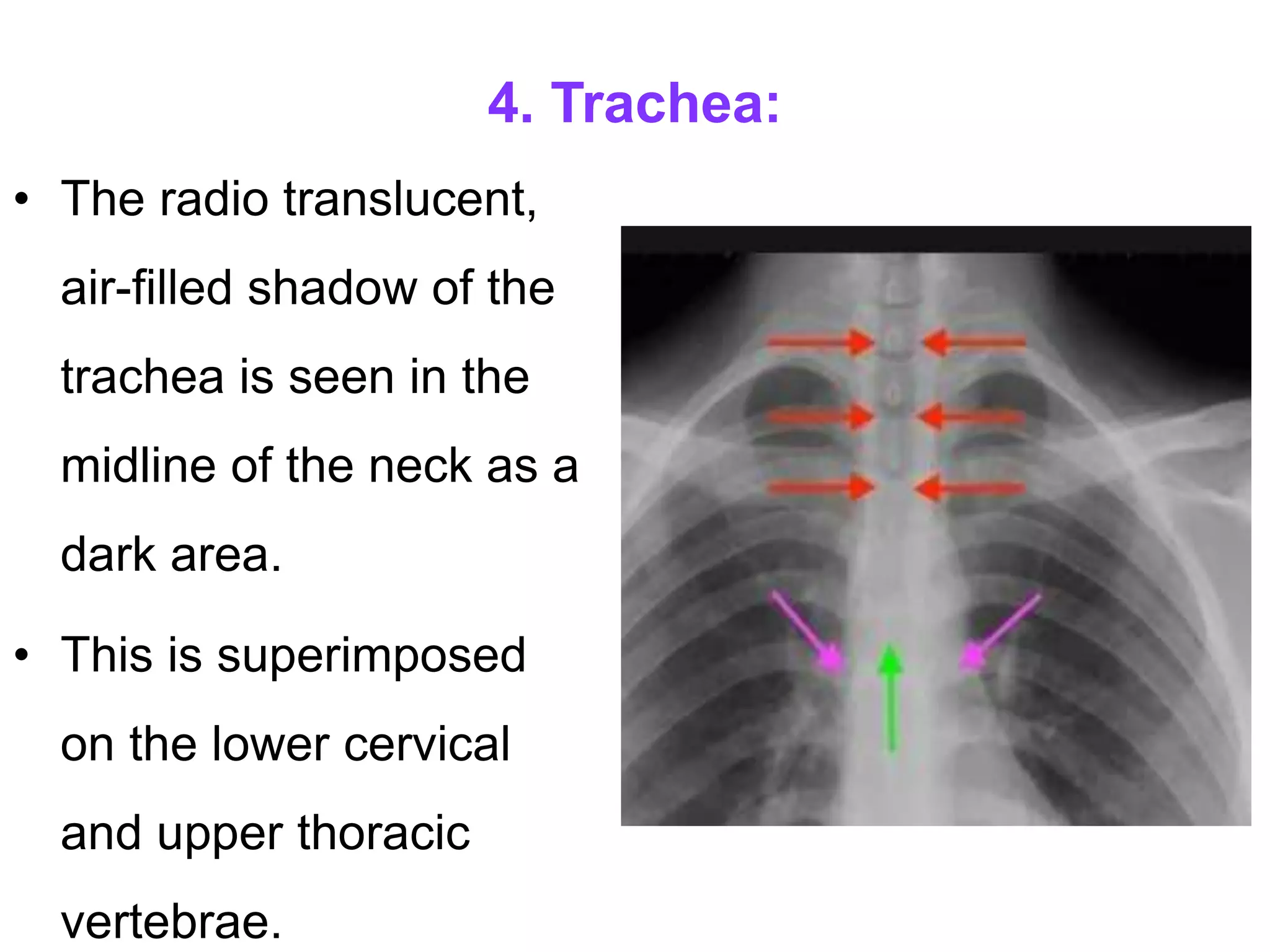 Radiographic anatomy of chest region | PPTX | Lung and Respiratory ...