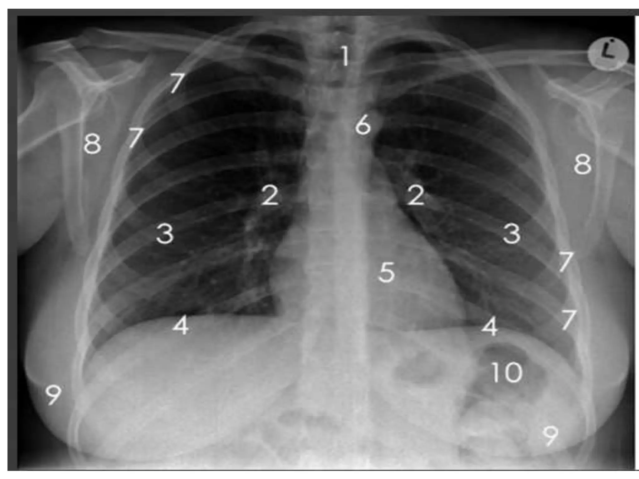 Radiographic anatomy of chest region | PPTX | Lung and Respiratory ...