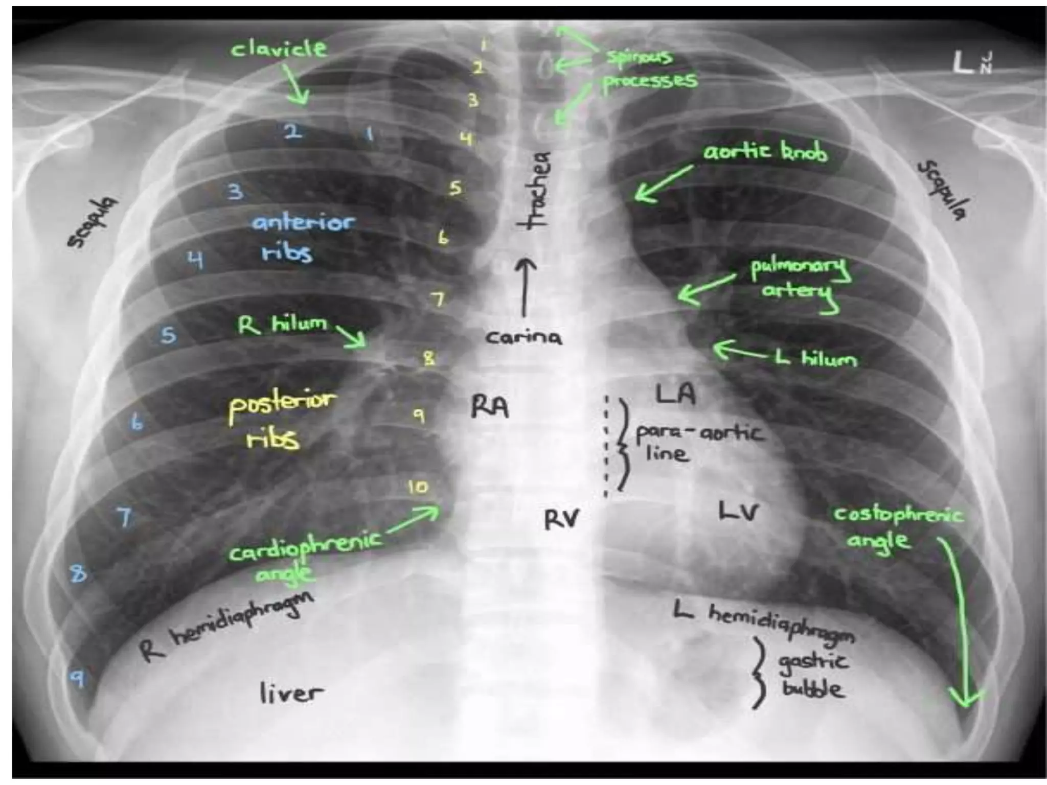 Radiographic anatomy of chest region | PPTX | Lung and Respiratory ...