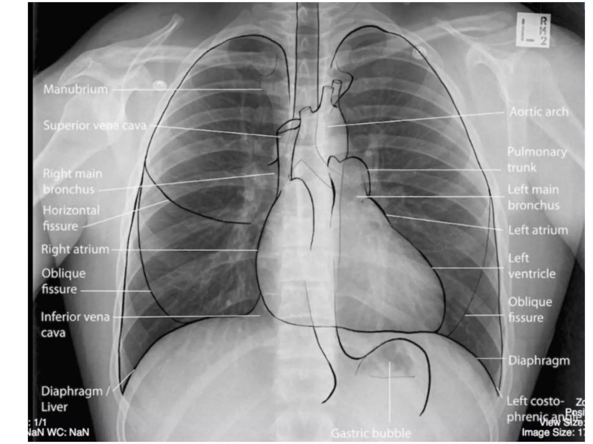 Radiographic anatomy of chest region | PPTX | Lung and Respiratory ...