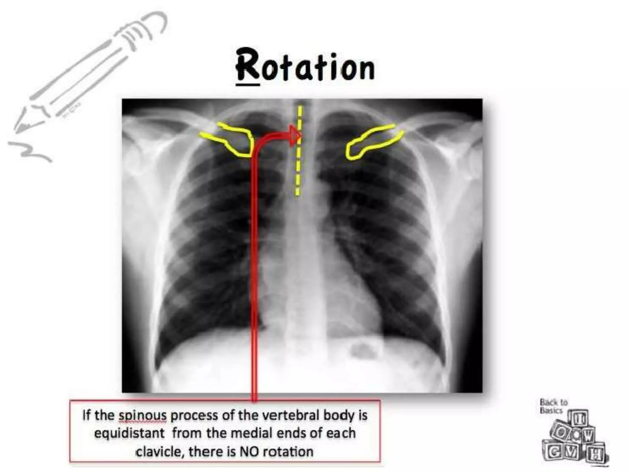 Radiographic anatomy of chest region | PPTX | Lung and Respiratory ...