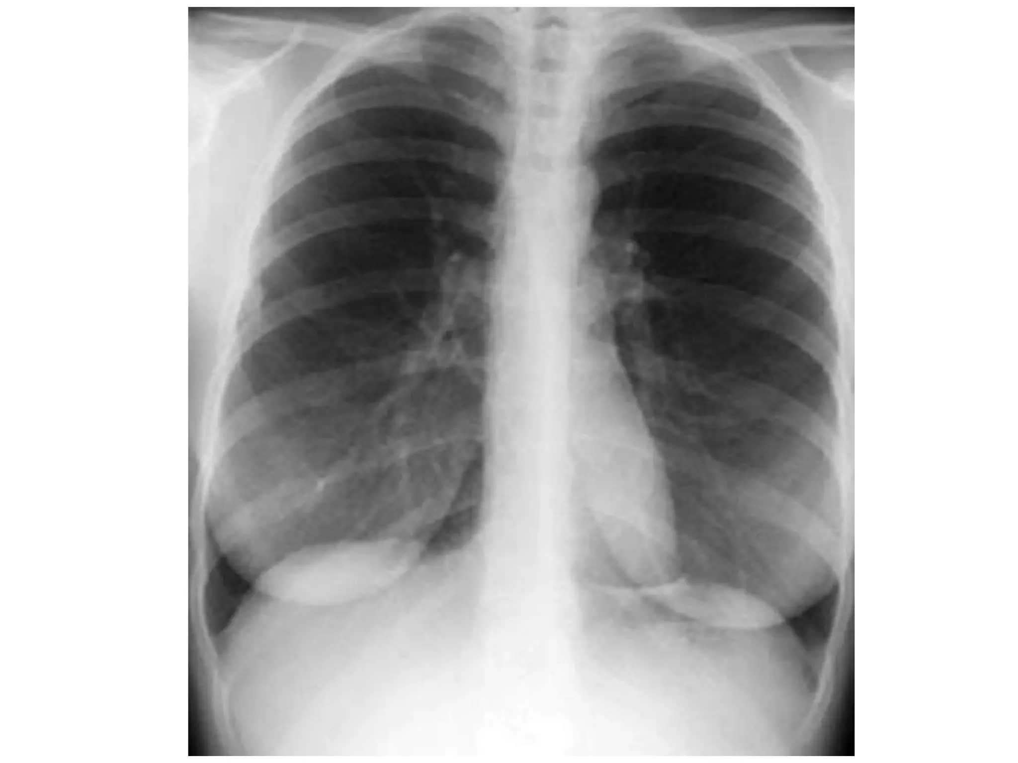 Radiographic anatomy of chest region | PPTX | Lung and Respiratory ...