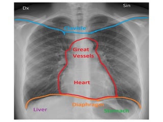 Radiographic anatomy of chest region | PPTX