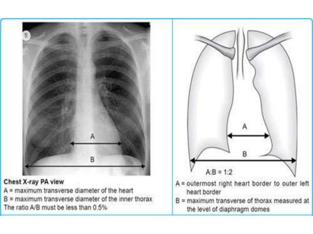 Radiographic anatomy of chest region | PPTX | Lung and Respiratory ...