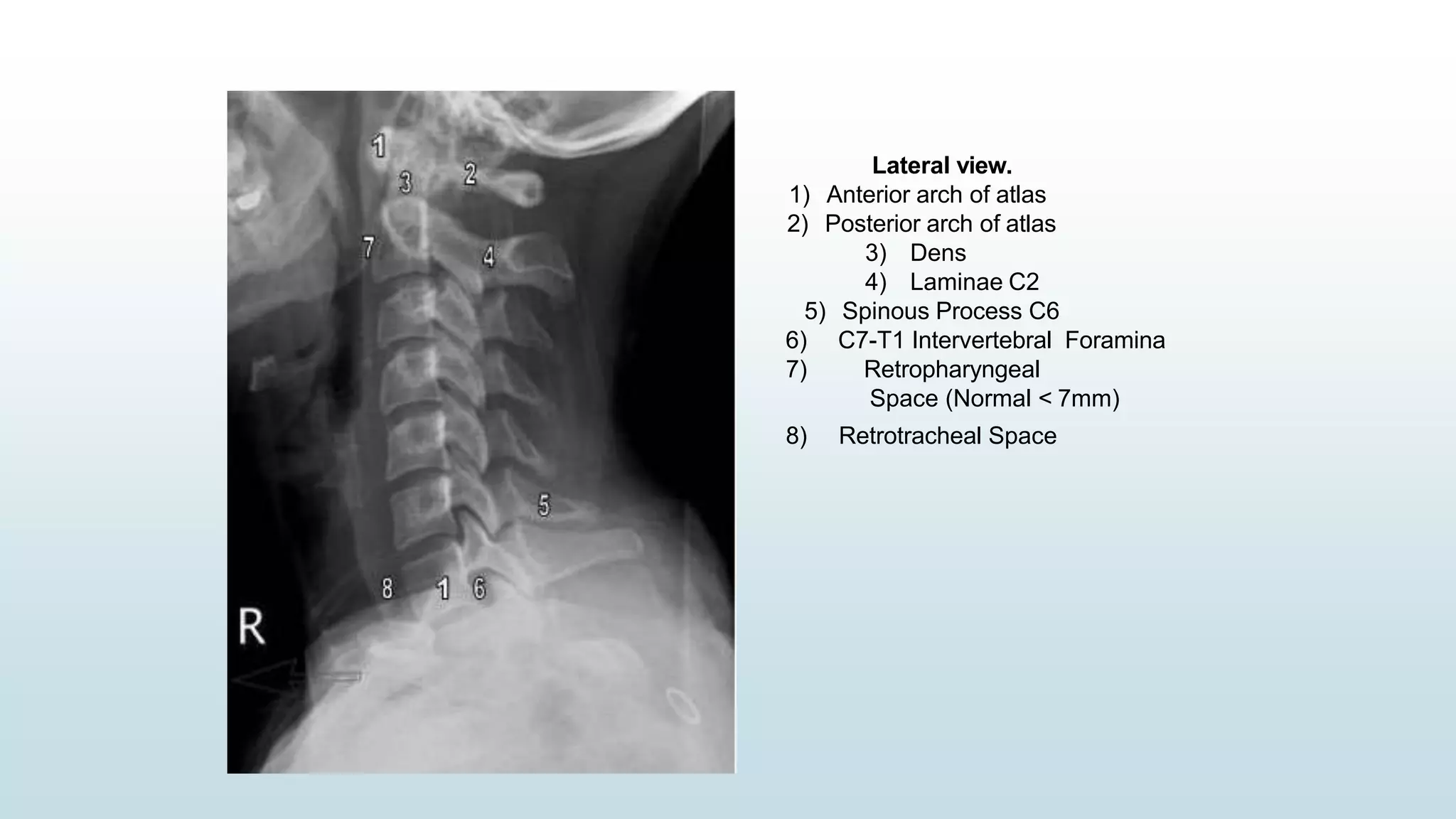 Radiographic anatomy and views of c spine | PPTX