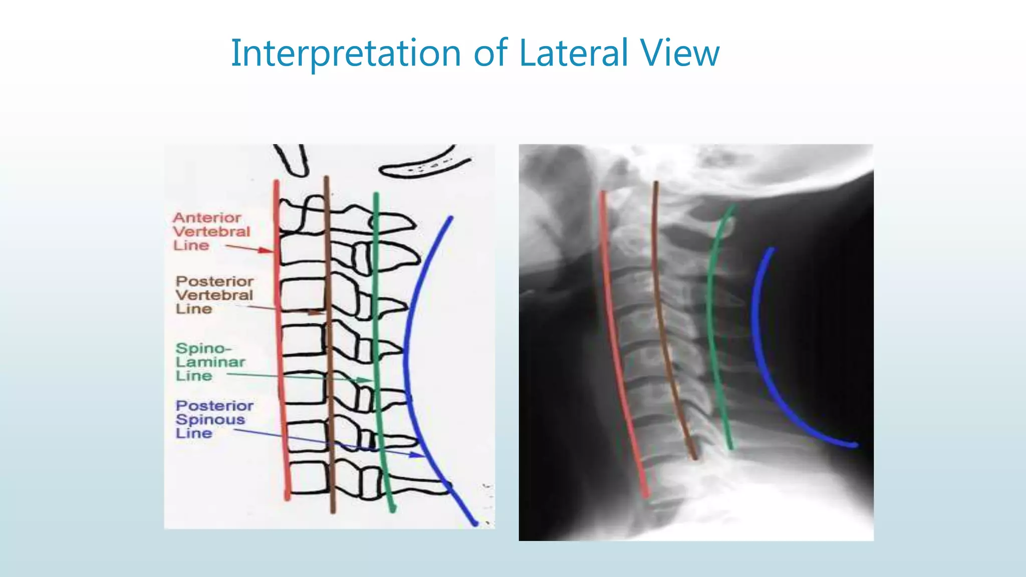 Radiographic anatomy and views of c spine | PPTX