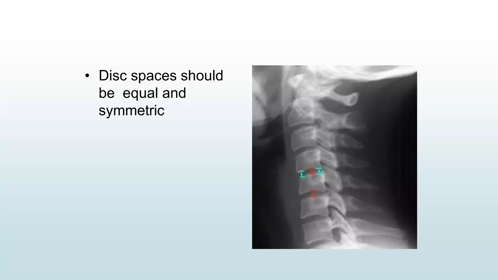 Radiographic anatomy and views of c spine | PPTX