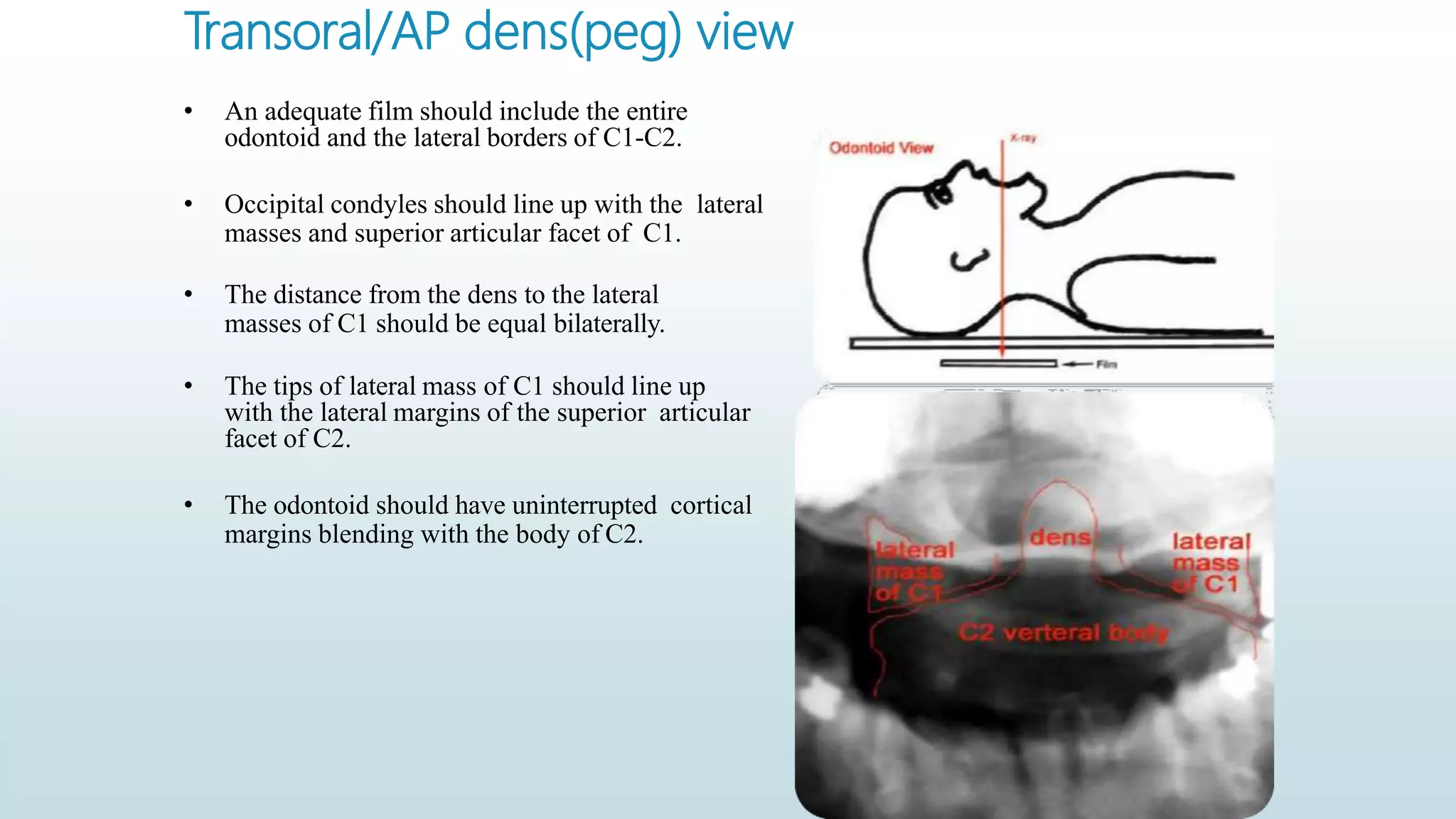 Radiographic anatomy and views of c spine | PPTX