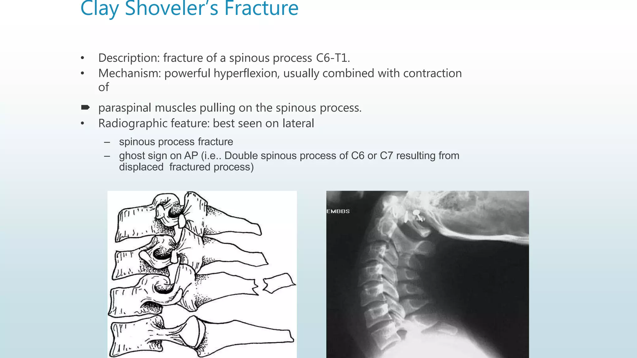 Radiographic anatomy and views of c spine | PPTX