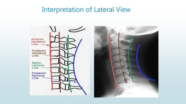 Radiographic anatomy and views of c spine | PPTX | Death, Injury, or ...
