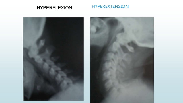 Radiographic anatomy and views of c spine | PPTX | Death, Injury, or ...