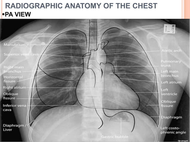 Radiographic Anatomy(chest abdomen and skeletal).pptx