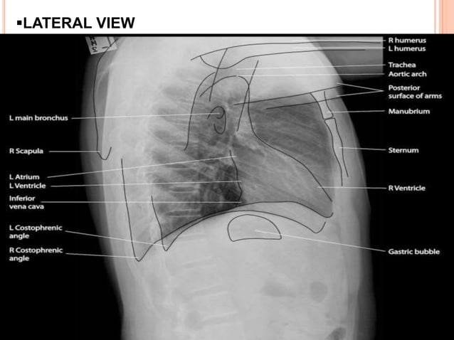 Radiographic Anatomy(chest abdomen and skeletal).pptx